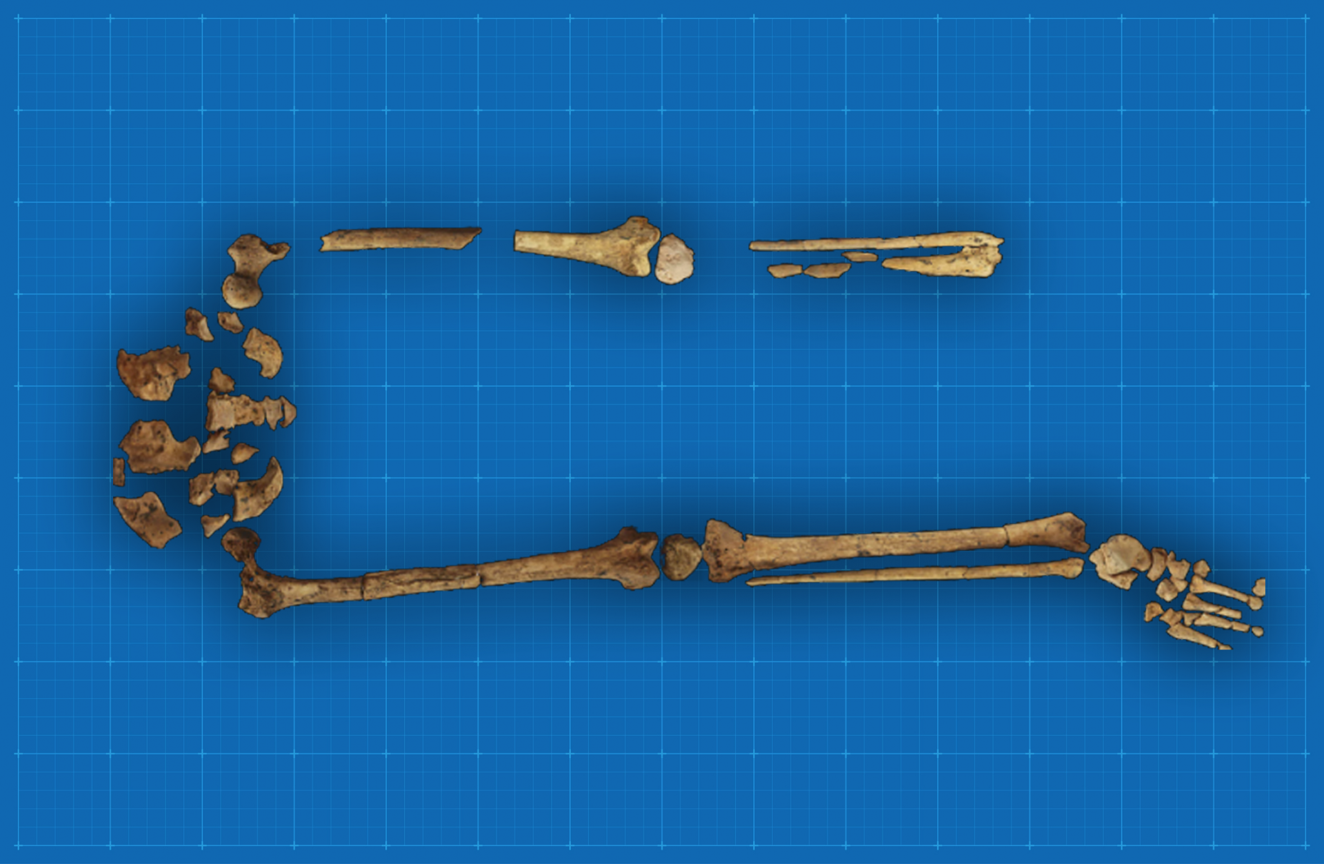 A discovery pushes the earliest known medical amputation back 31,000 years