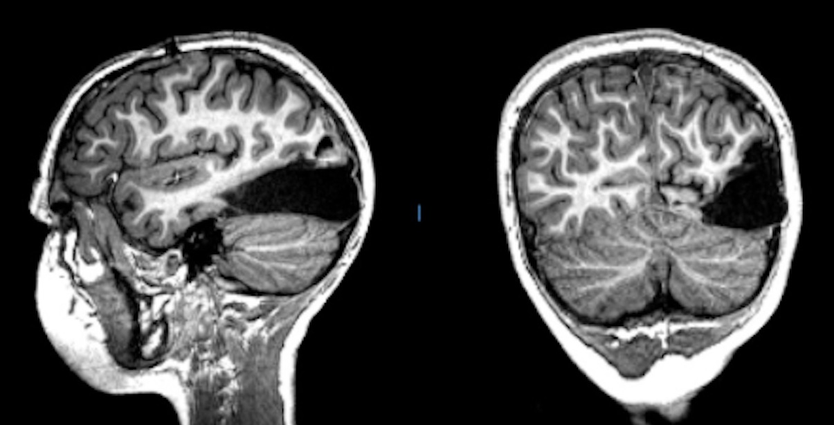 Boy Who Had One-Sixth of His Brain Removed Adapts to Function ...