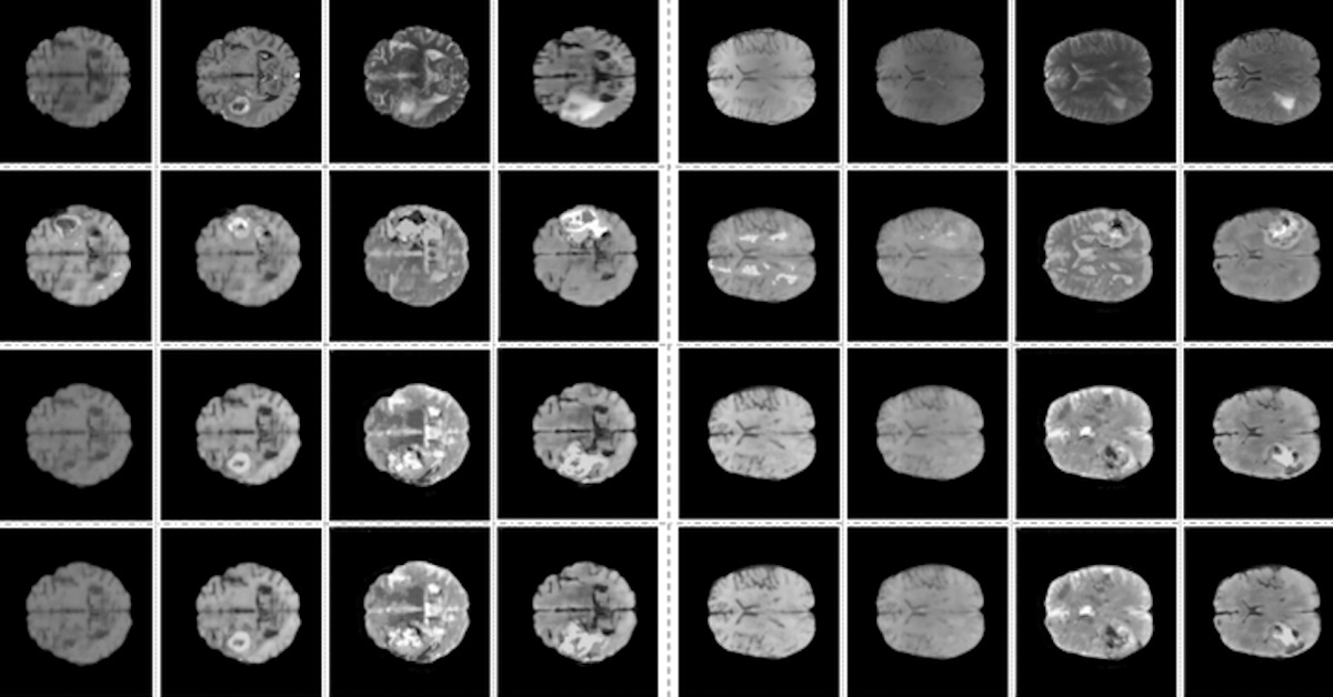 Researchers Use Deep Learning Network to Create Synthetic Brain MRI Images