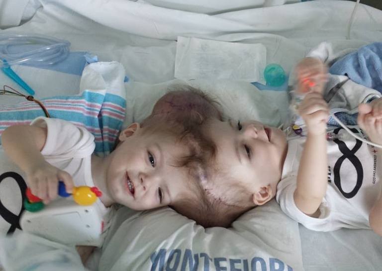 Doctors Successfully Separate Twin Boys Conjoined at the Head