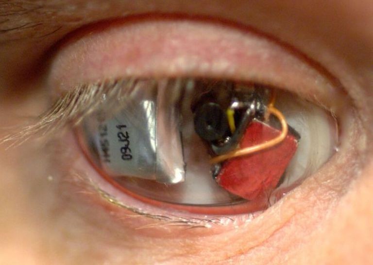 Filmmaker 'Eyeborg' Replaced His Deteriorating Eye with a Video Camera