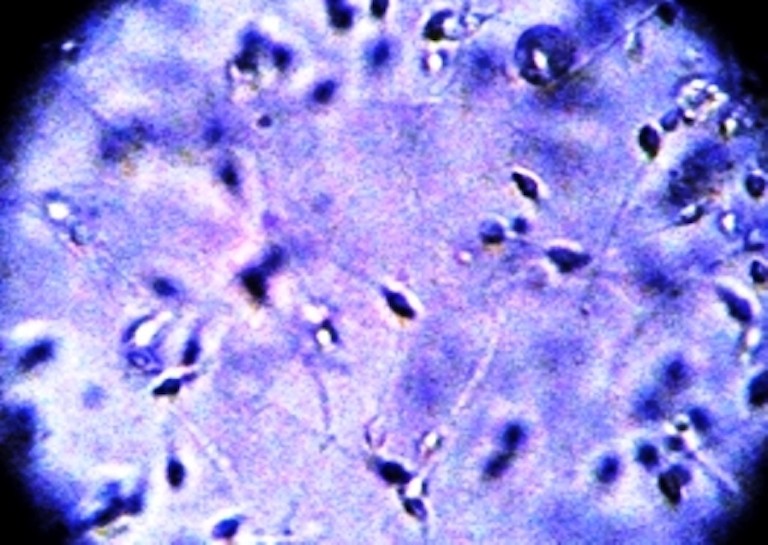 Smartphone Microscope Enables Men to Check Their Sperm Count at Home