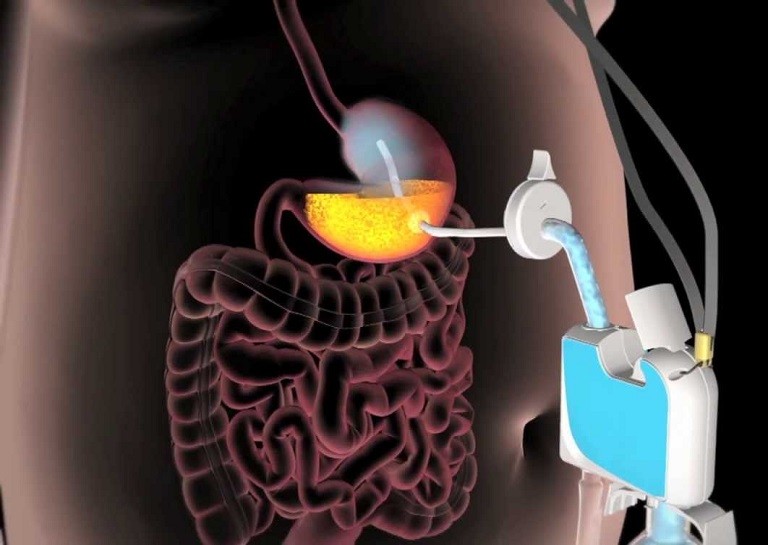 FDA Approves New Weight Loss Stomach Pump that Sucks Food Right Out of ...