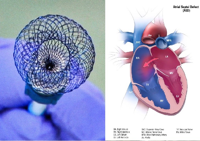 A New Way to Heal Hearts with Non-Invasive Surgery