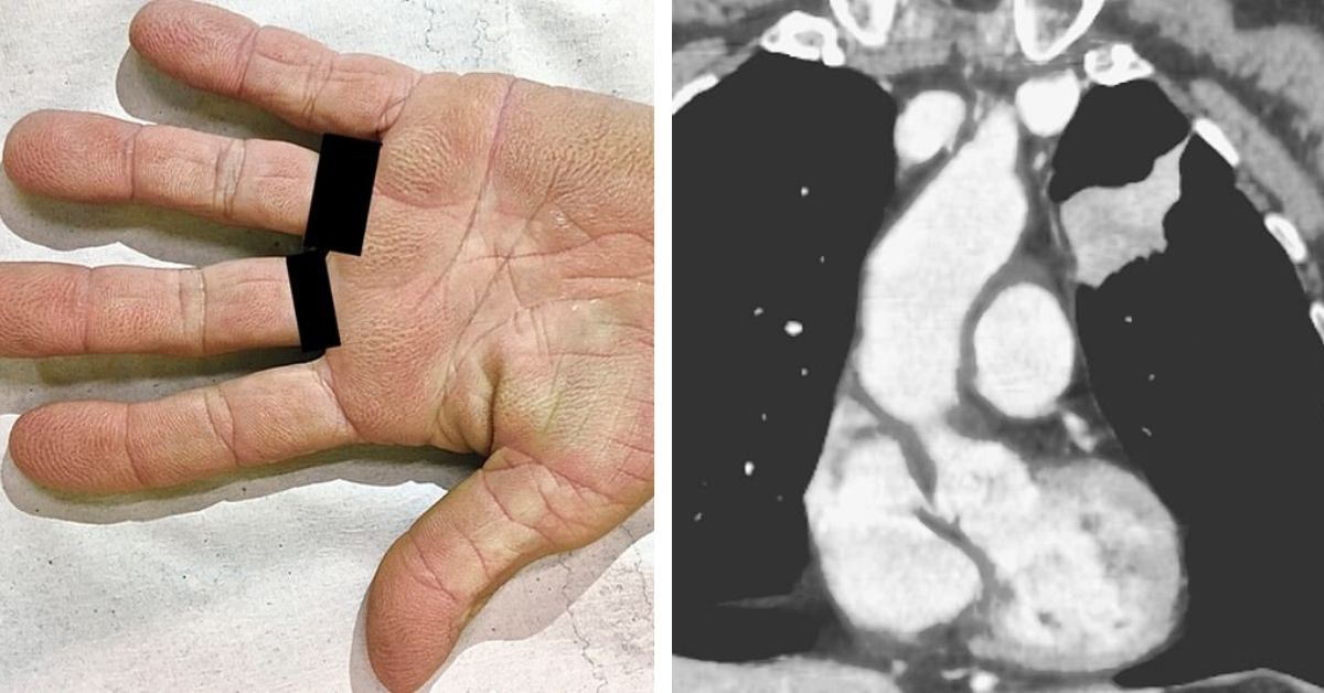 Lung Cancer Detected in Brazilian Woman Due to Her 'Velvety Palms'