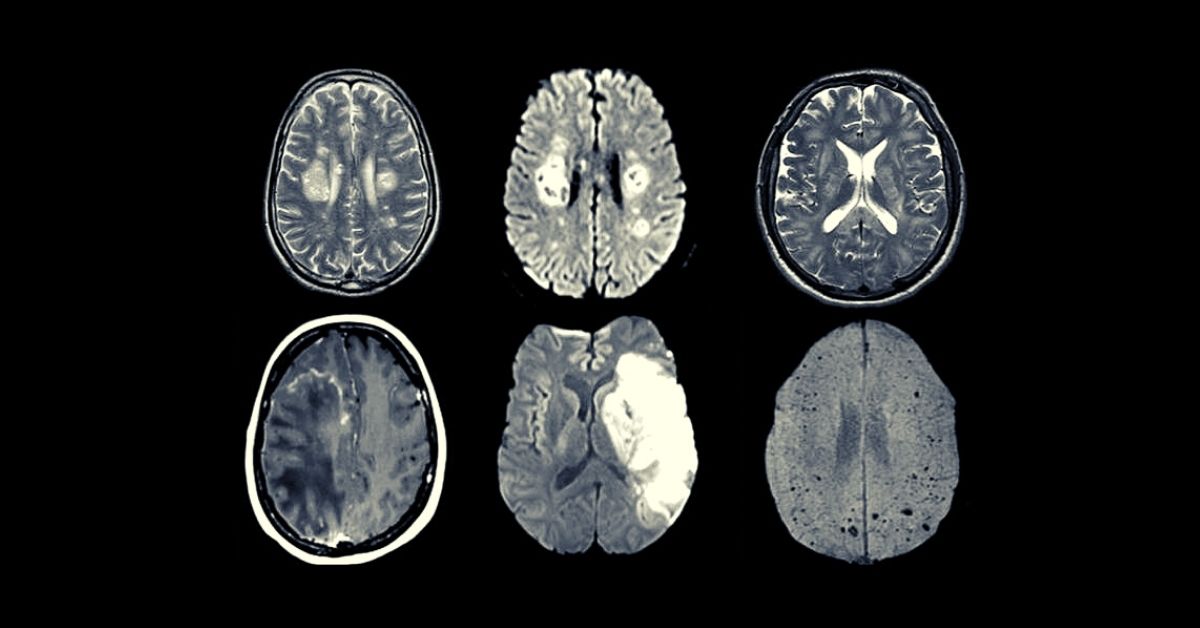 Coronavirus Infects, Hijacks Brain - How Does It Work? | IE