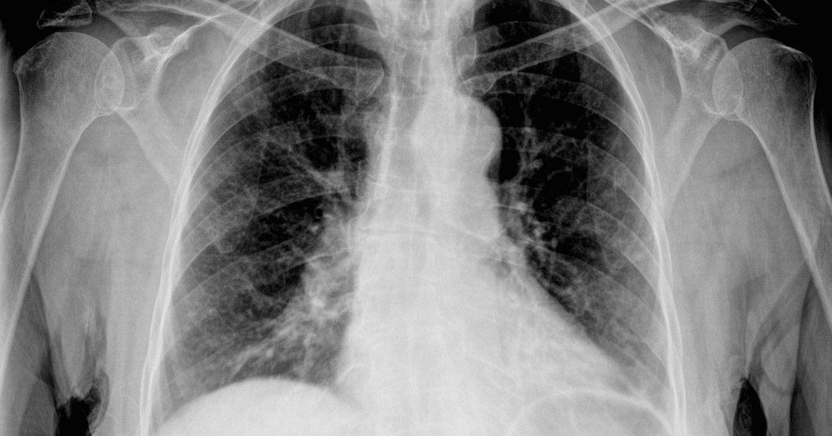 New Study Finds That Fat Accumulates in the Lungs of Obese and ...