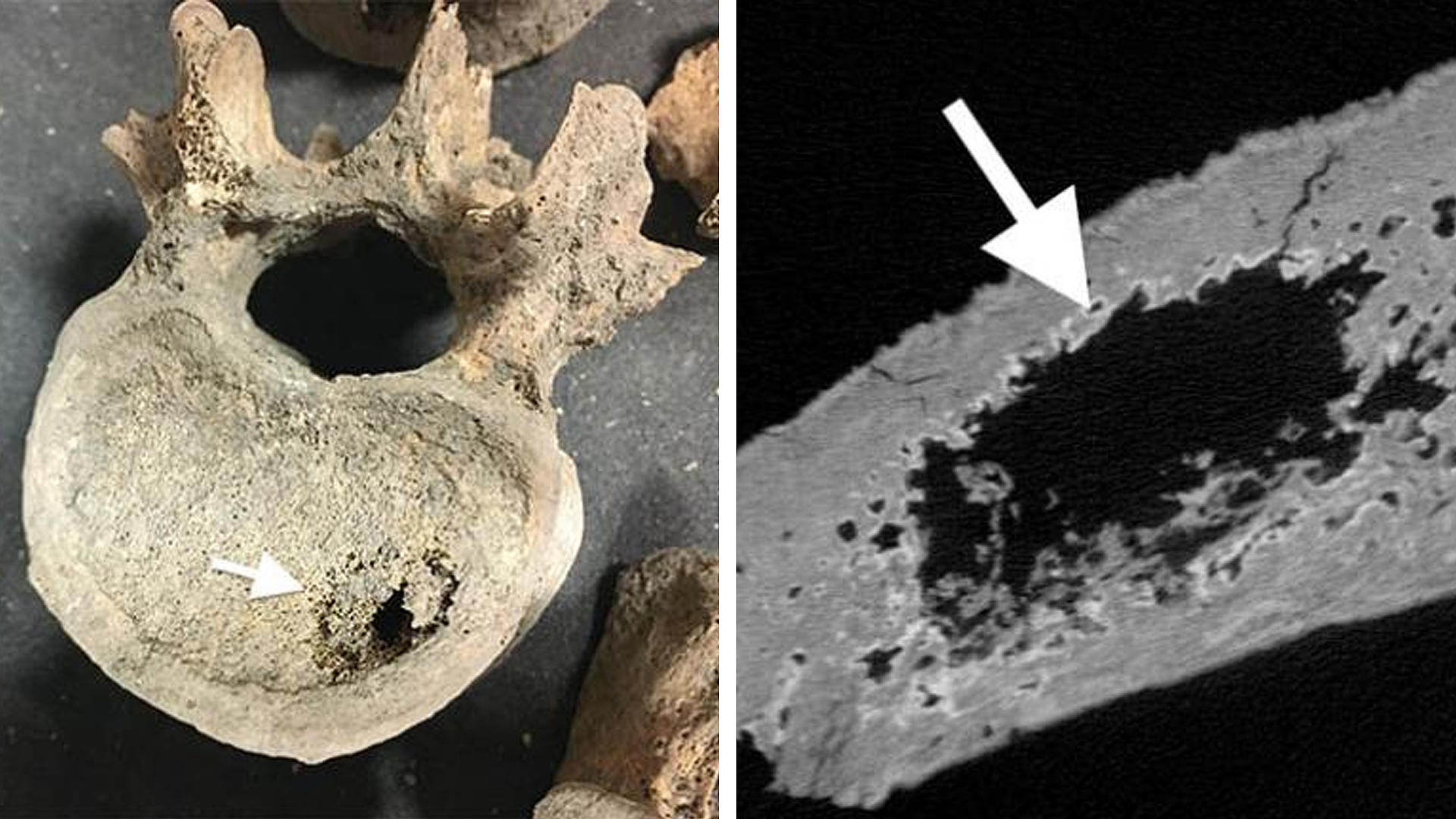 Cancer Was Common Even in Medieval Times, Study Suggests | IE