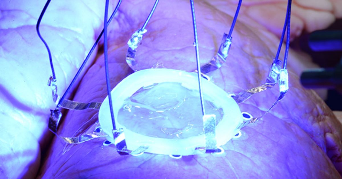3D Printing Sensors Directly Onto Expanding Organs Is Now Possible
