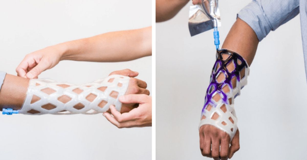 Start-Up Creates Mesh-Like, Breathable, Lightweight Arm Cast