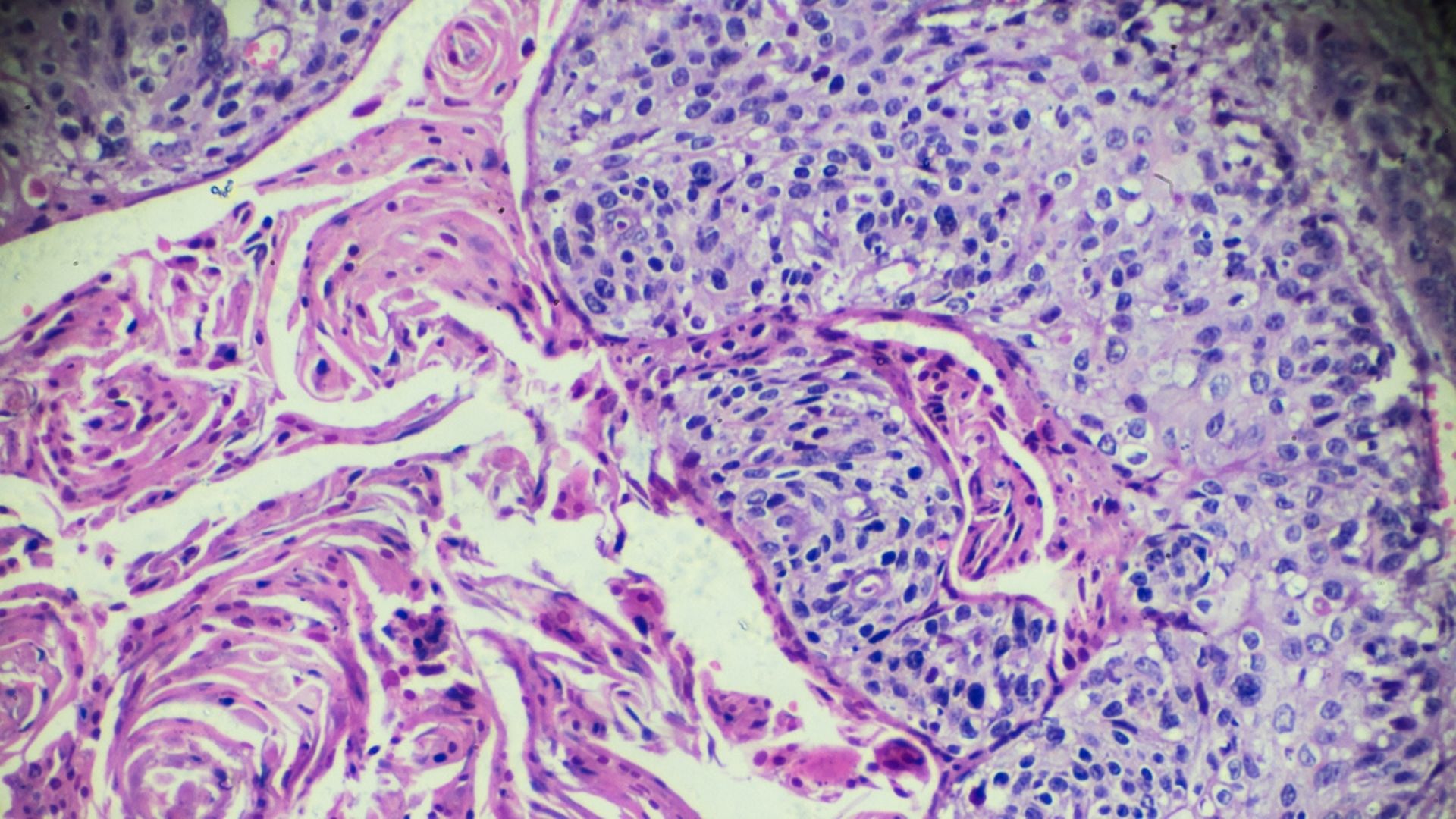 The HPV Vaccine Reduced Cervical Cancer Cases by Almost 90%