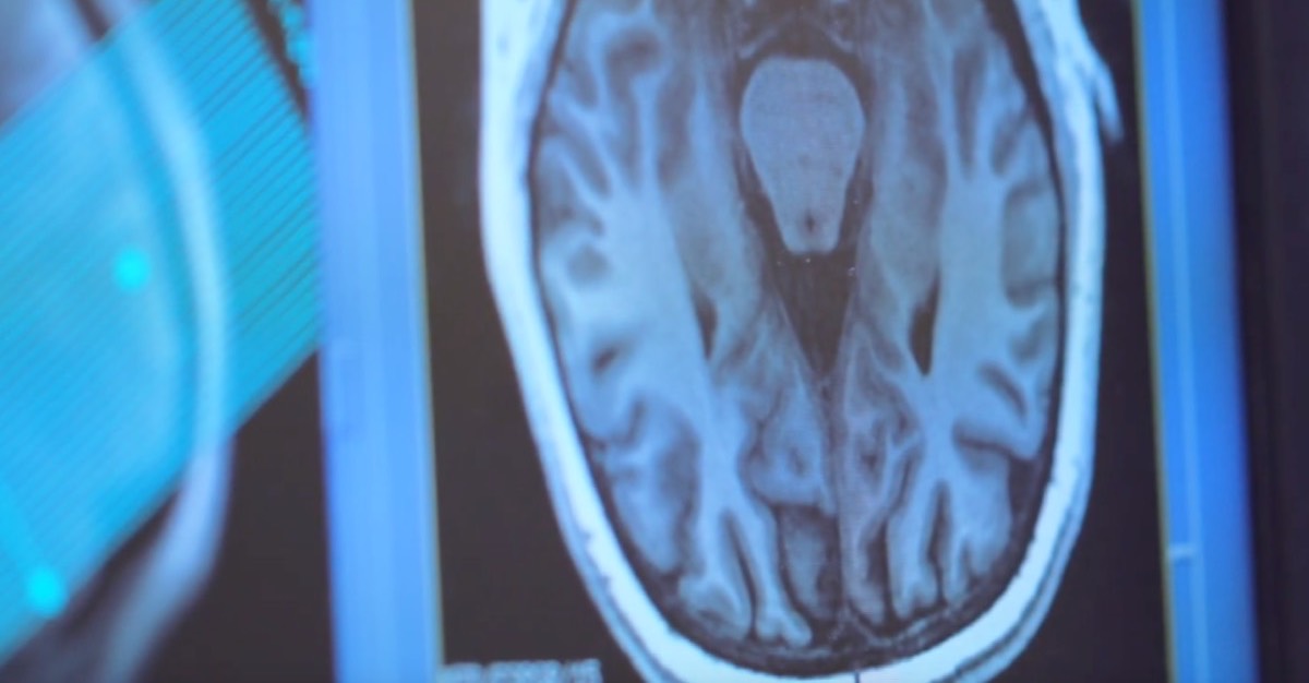 Intense Pokémon Playing as a Child Changes the Topography of Your Brain