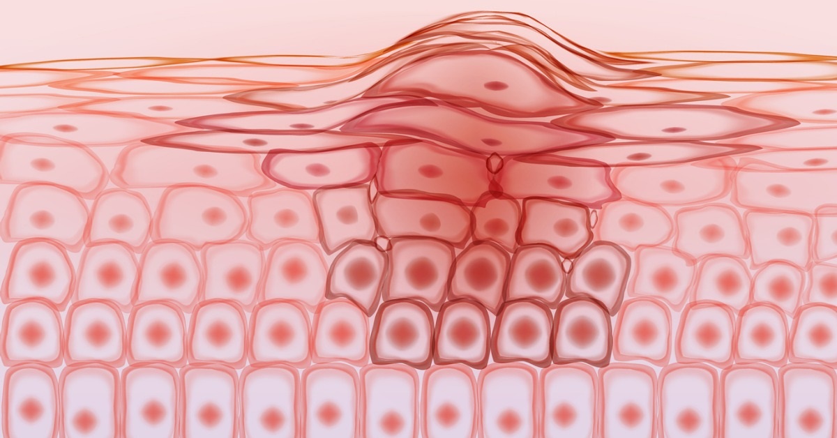 New Pain-free Skin Patch Treatment Could Be Used to Fight Cancer